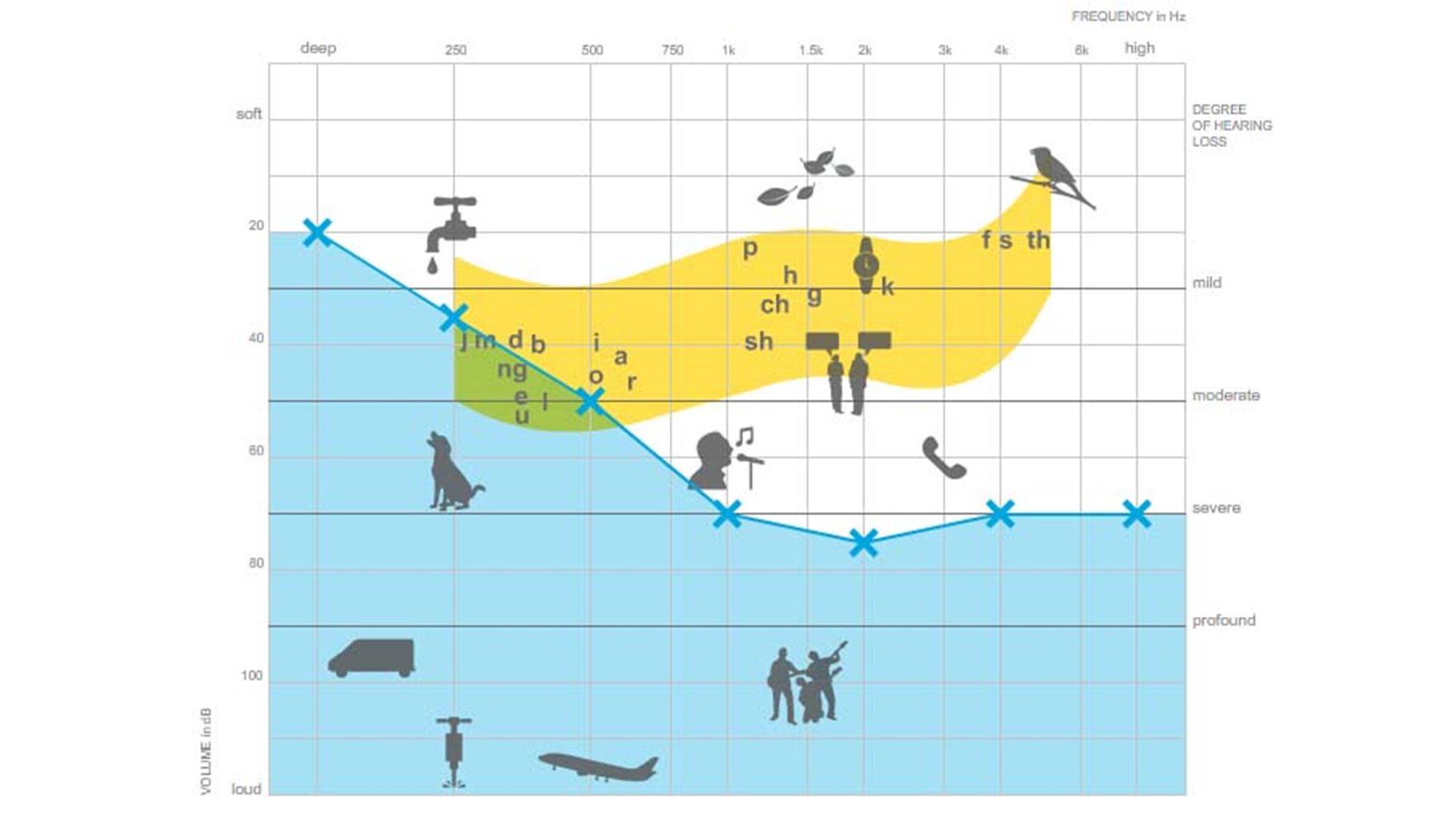 The 3 types of hearing loss: Sensorineural, Conductive and Mixed | Signia