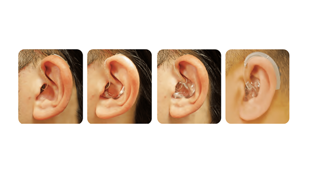 補聴器と一緒に使うイヤモールドとは？快適性と効果を最大化する秘訣 | Signia